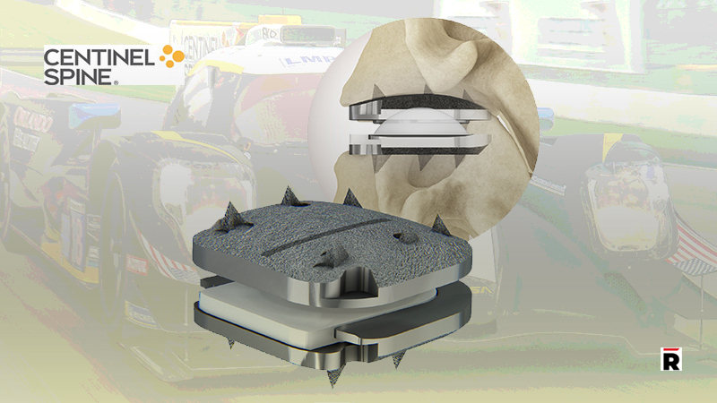Centinel Spine Announces First Commercial Use of the prodisc C Vivo
