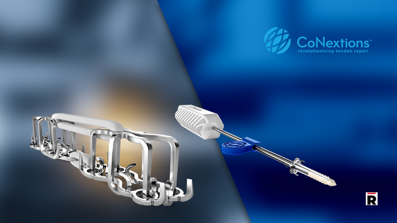 CoNextions Inc. Announces First Patient Treated with CoNextions TR