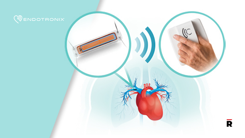 Endotronix Announces End of Enrollment in Pivotal PROACTIVE-HF Trial