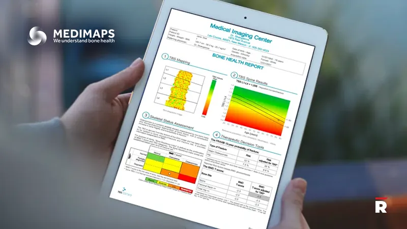 Medimaps Group Unveils In Europe TBS Osteo Next-Gen Software