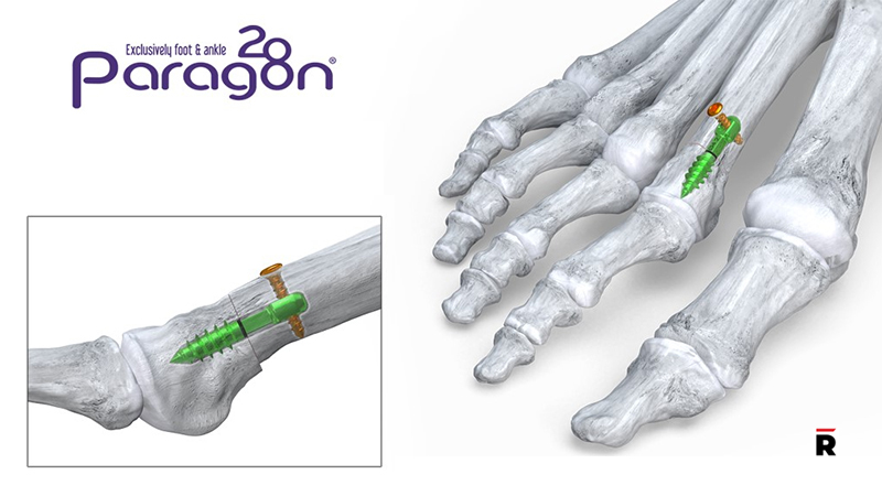 Paragon 28 Launches Phantom Metatarsal Shortening System