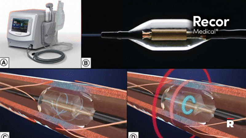 Recor Medical and Otsuka Medical Devices Announce First FDA-Approved Renal Denervation System ...