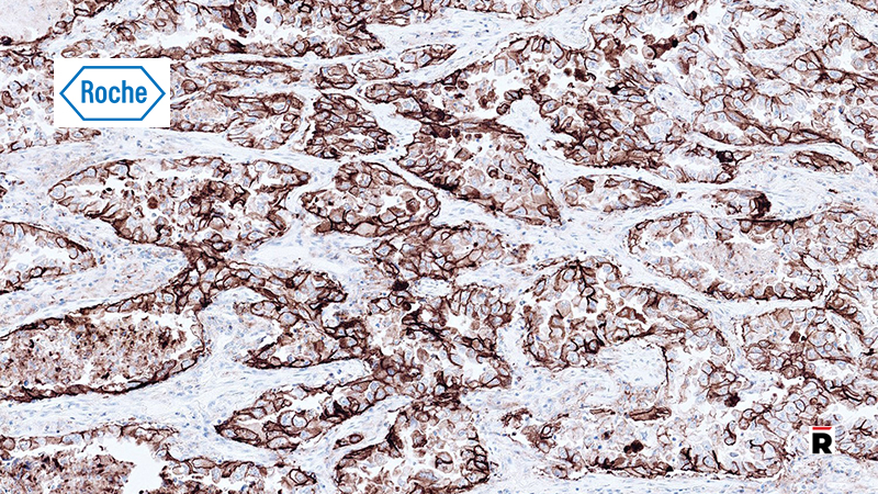 Roche VENTANA PD-L1 test gains CE label expansion