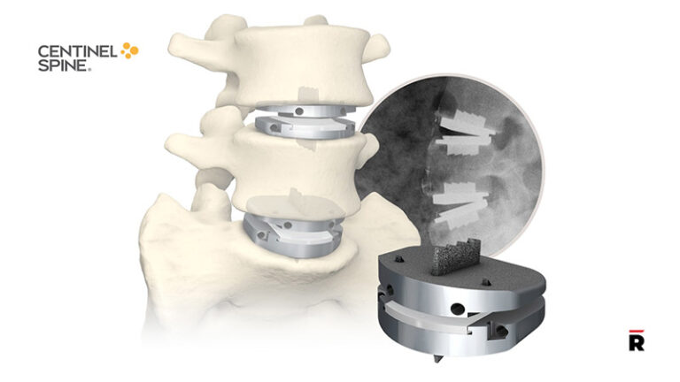 Long-Term Effectiveness of Centinel Spine's Prodisc L Disc Replacement