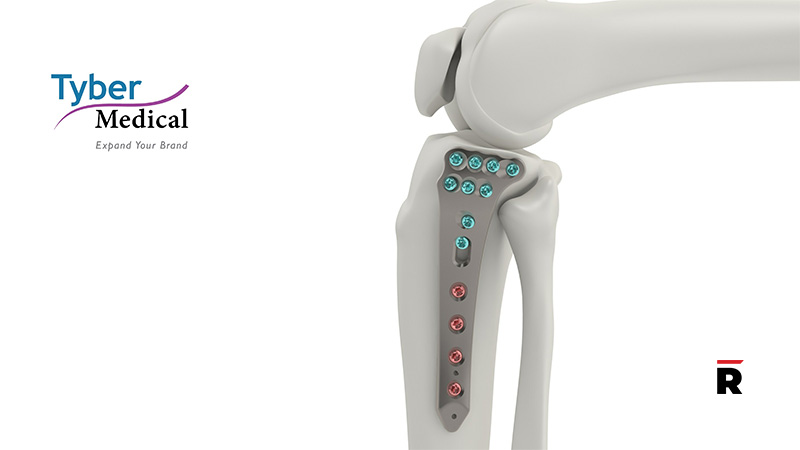Tyber Medical Acquires FDA Clearance for Proximal Tibia Plating System