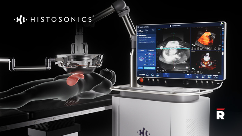 World’s First Patients Treated With Novel Edison® Histotripsy System